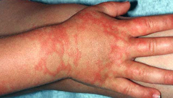 Erythema Infectiosum Lacy Rash